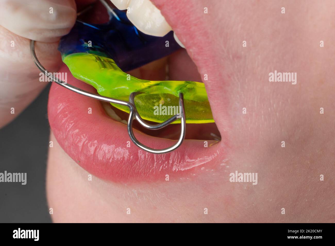 Plate for lower teeth, orthodontist and plate for teeth of the lower ...