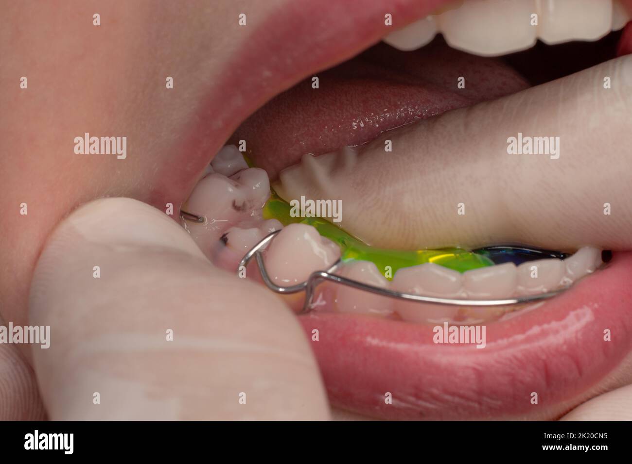 The child has two teeth with caries, plaque and caries on the teeth ...