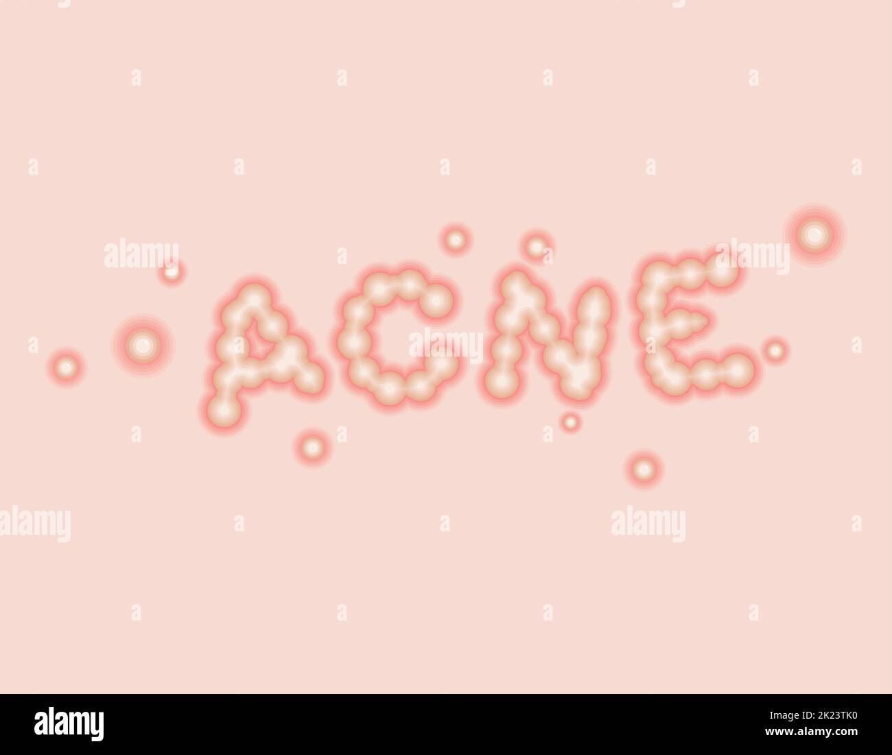 Acne lettering. Pimple lettersTypography. whelk typography Vector ...