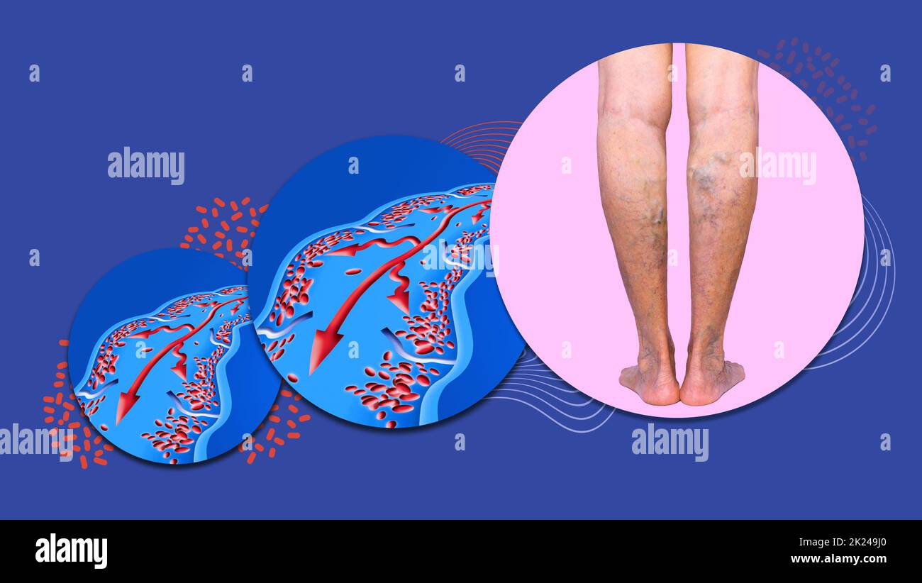 Varicose veins on a female senior legs. The structure of normal and ...