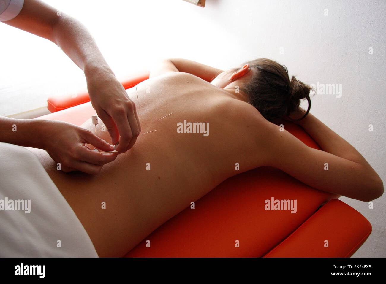 woman relaxes from acupuncture procedure. An acupuncturist doong acupuncture very accurately ...