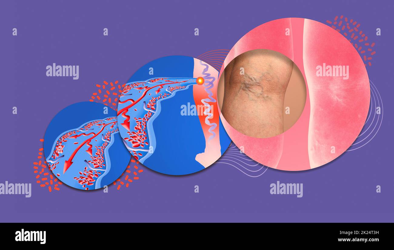 Varicose veins on a female senior legs. The structure of normal and ...