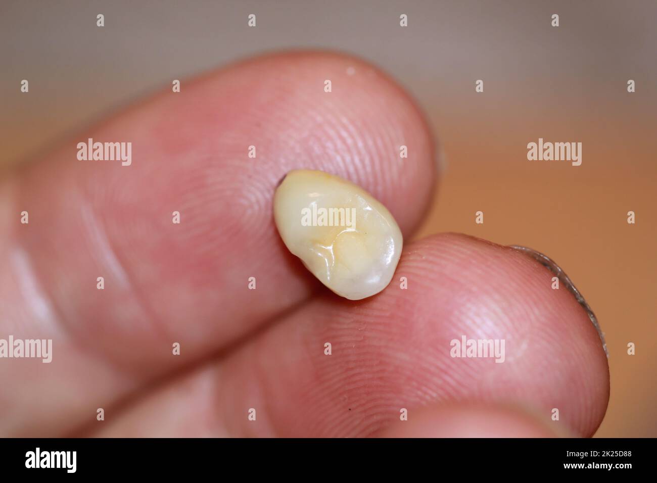 A loosened and fallen out crown of a tooth Stock Photo - Alamy