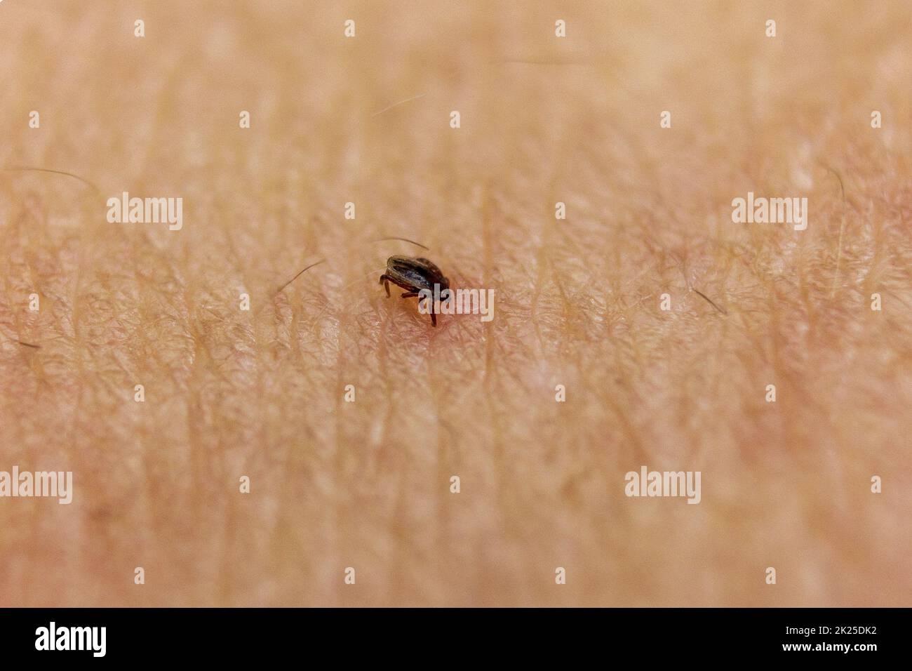 Tick bitten in human skin 7 Stock Photo - Alamy