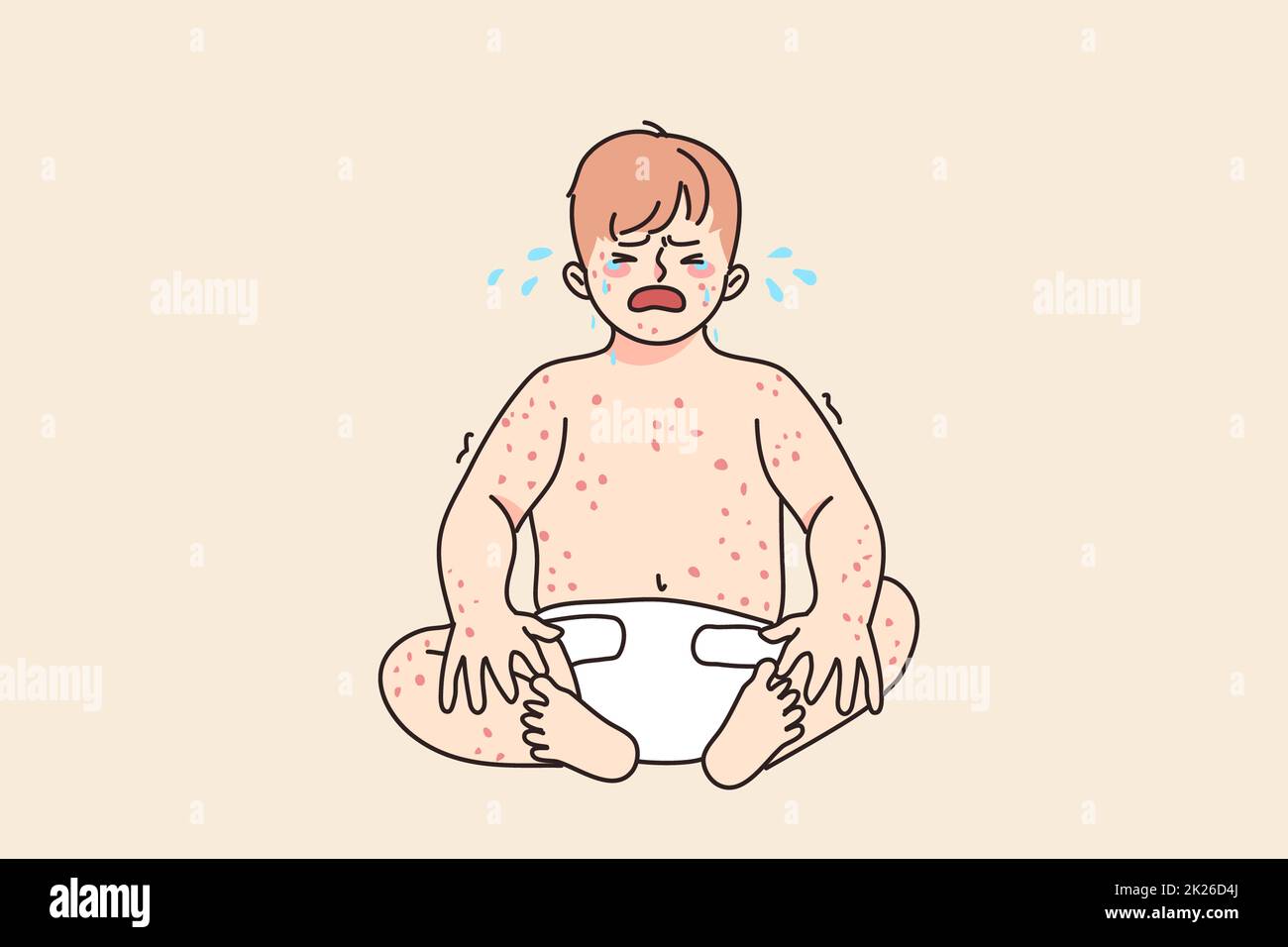 Unhappy baby crying suffer from eczema disease Stock Photo - Alamy