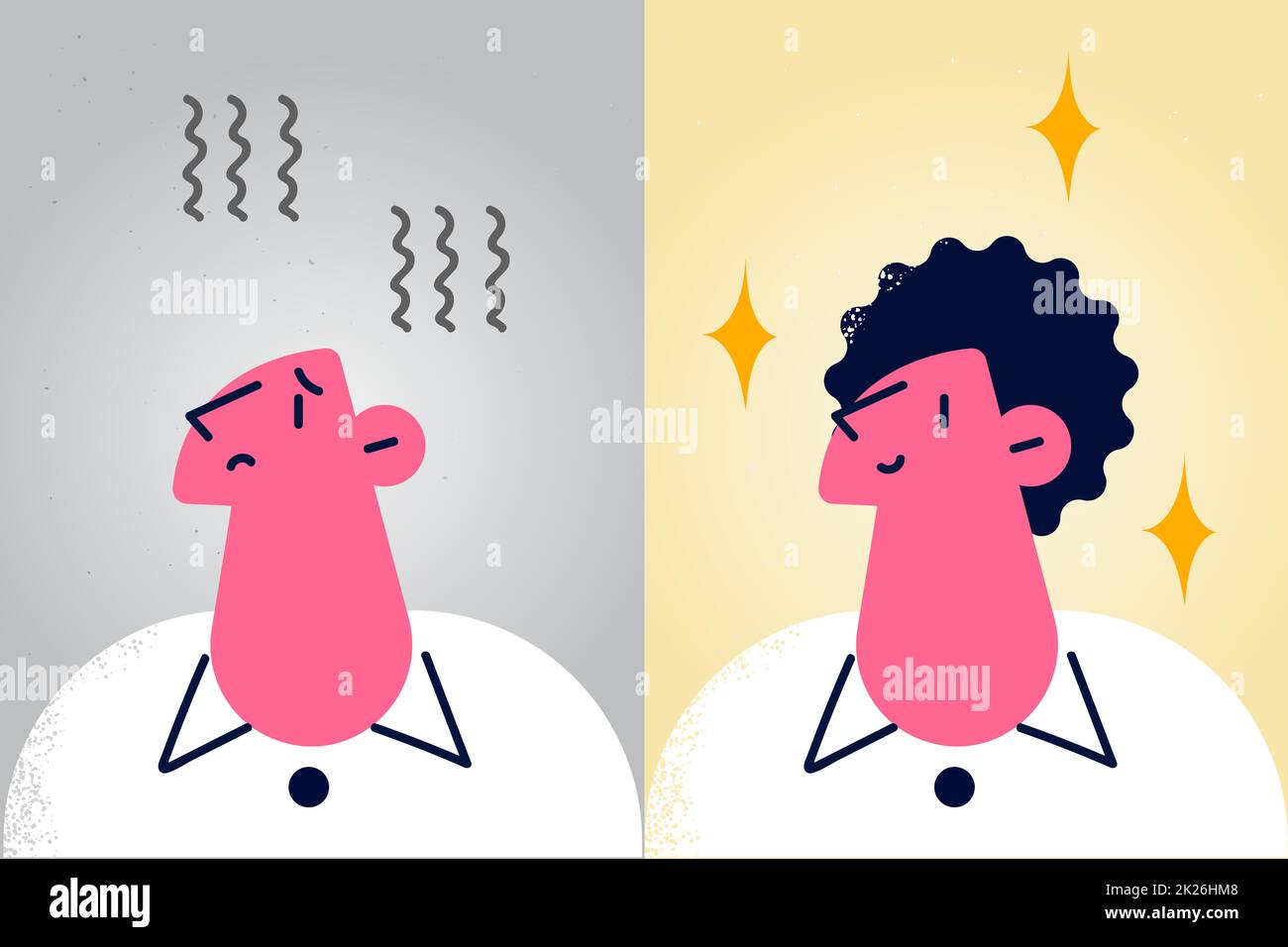 Man before and after hair transplantation Stock Photo - Alamy
