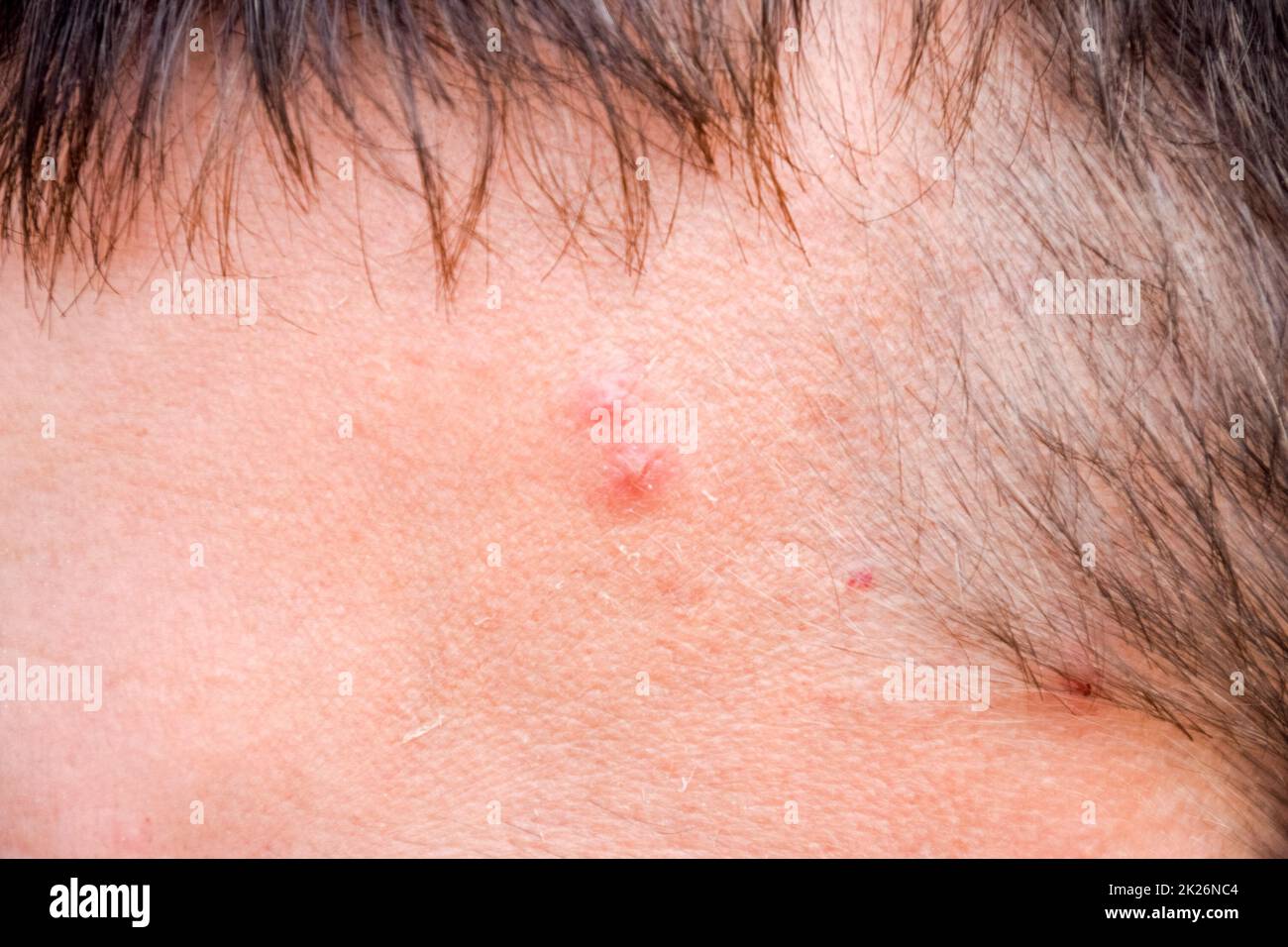 Pimples on the forehead of man. Acne on the forehead Stock Photo - Alamy