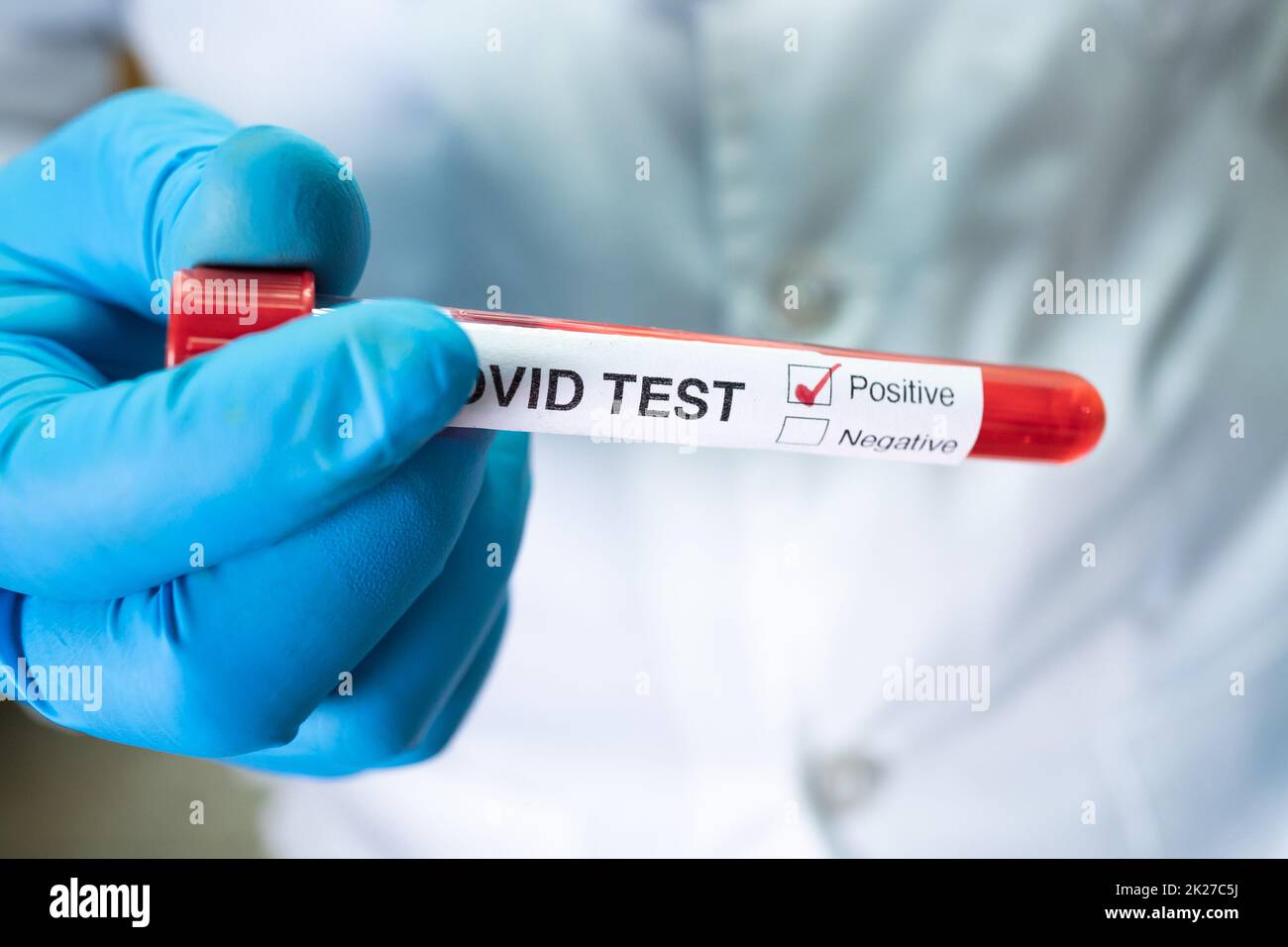 Positive blood infection sample in test tube for covid-19 coronavirus ...