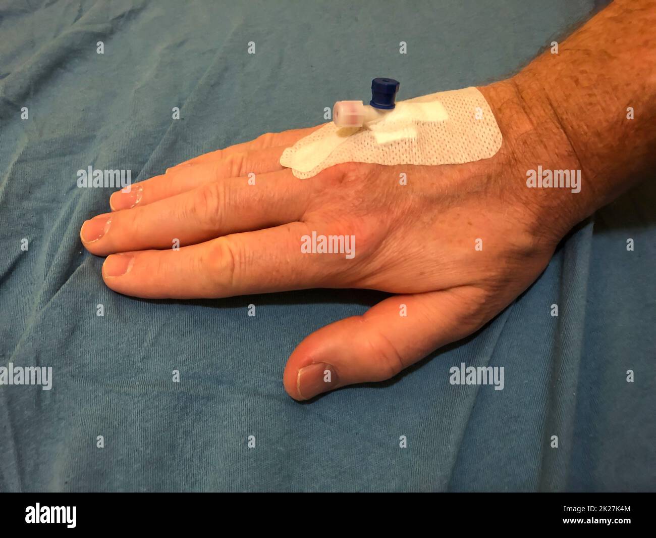 A cannula is stuck in one hand for vein access Stock Photo - Alamy