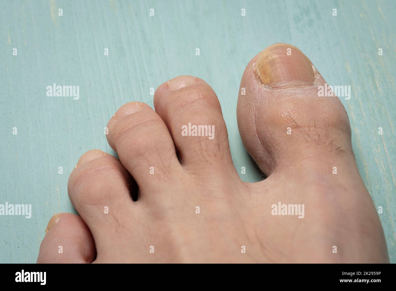 Toenails with fungus problems on green background Stock Photo - Alamy
