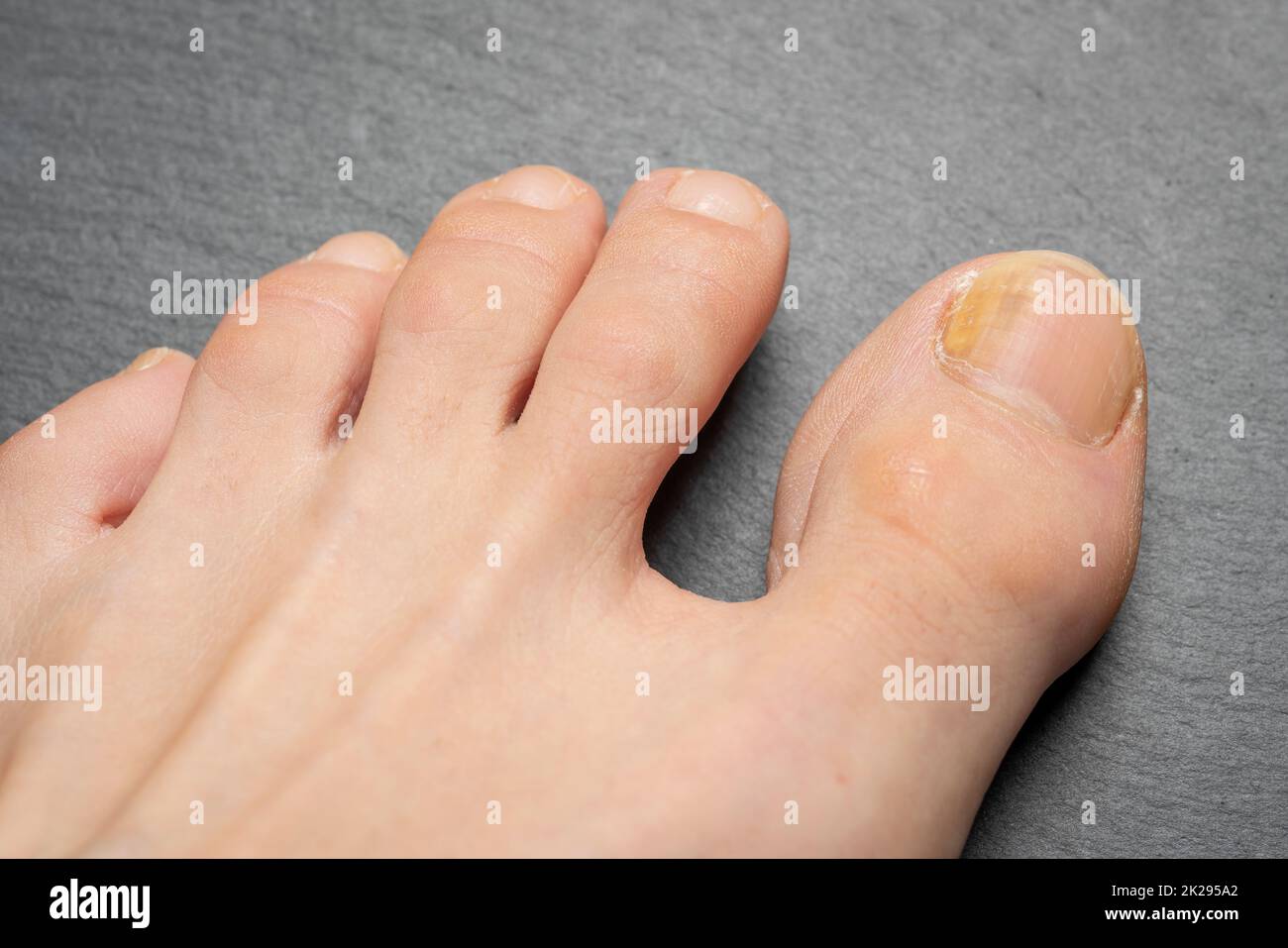 Toenails with fungus problems on gray background Stock Photo - Alamy