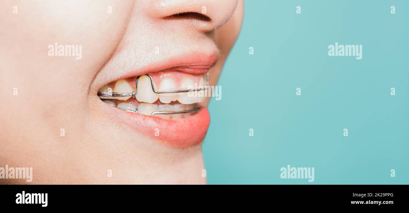 Close up white teeth of young Asian beautiful woman smiling wear ...