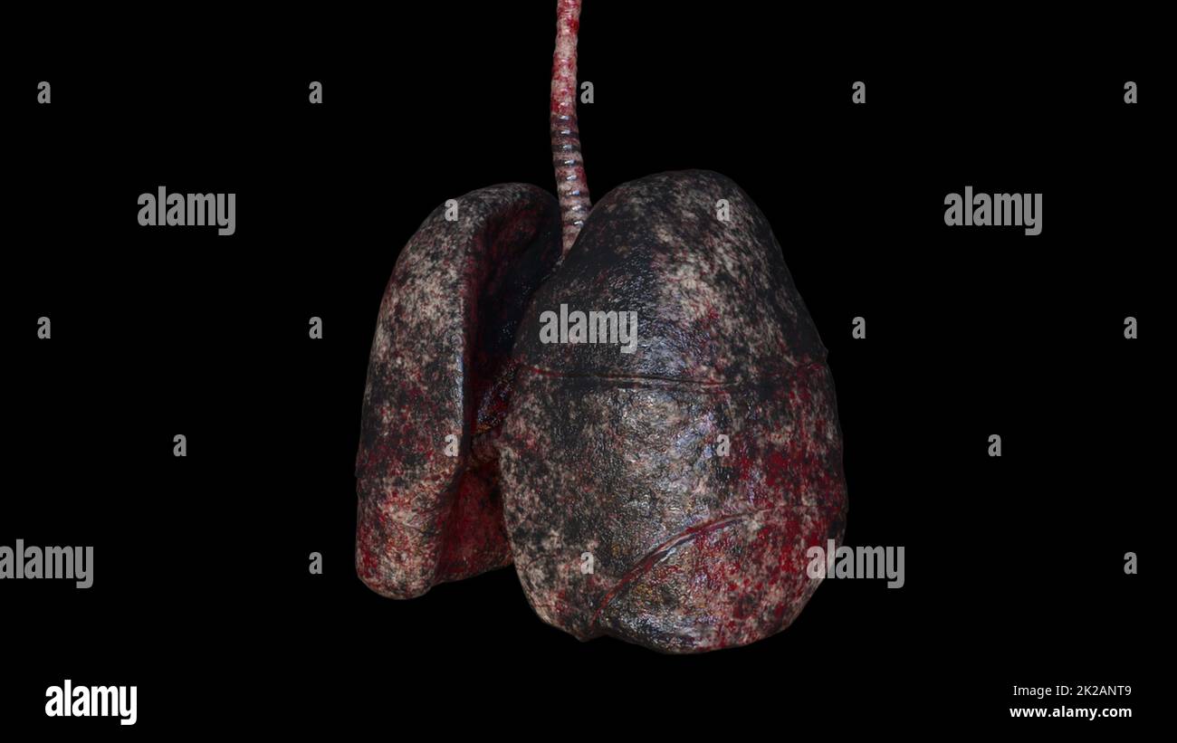 Affected lung cancer hi-res stock photography and images - Alamy