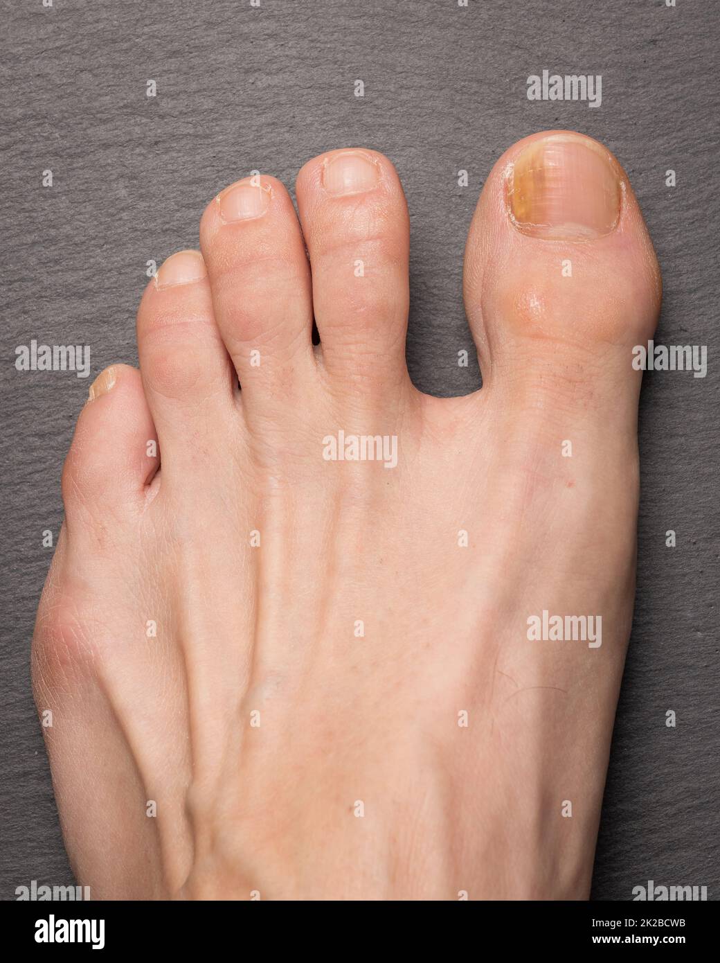 Toenails with fungus problems on gray background close up Stock Photo ...