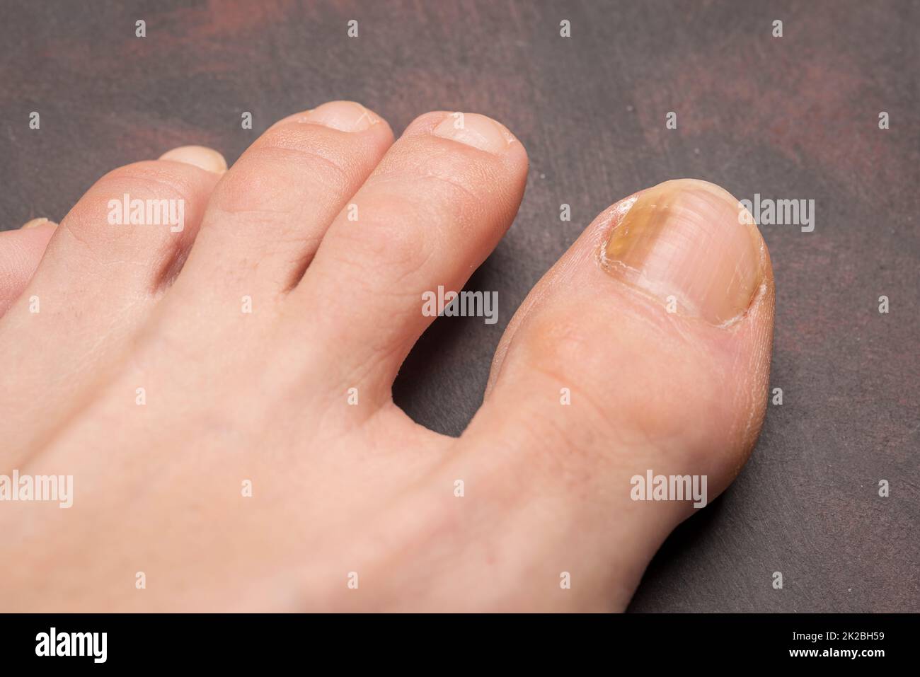 Toenails with fungus problems on background close up Stock Photo - Alamy