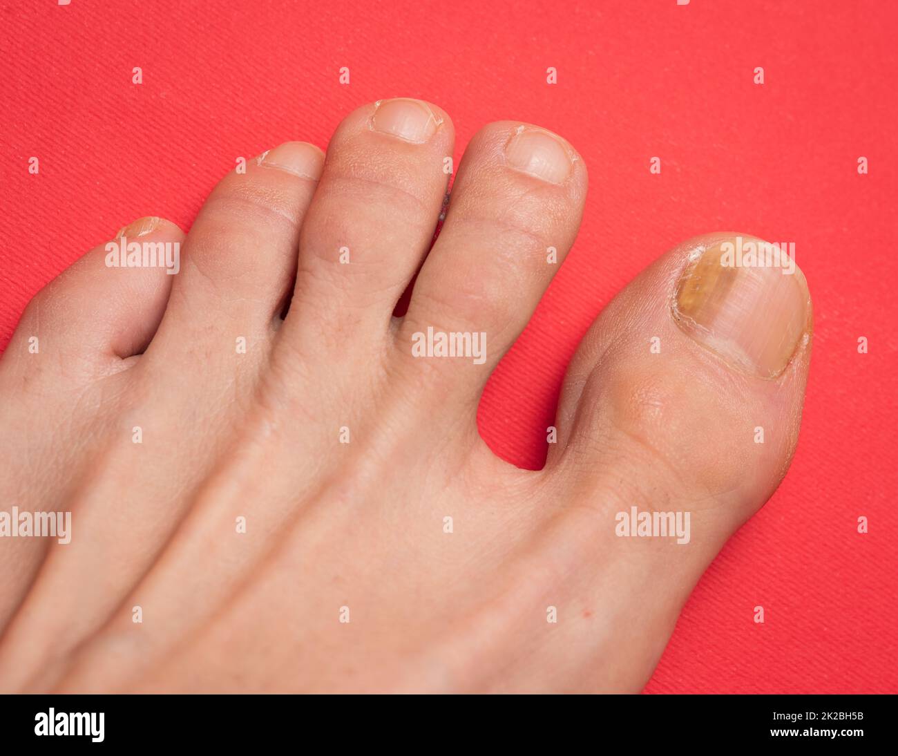 Toenails with fungus problems on red background close up Stock Photo ...