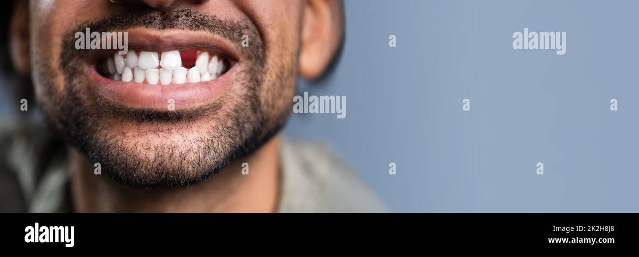 African missing teeth hi-res stock photography and images - Alamy