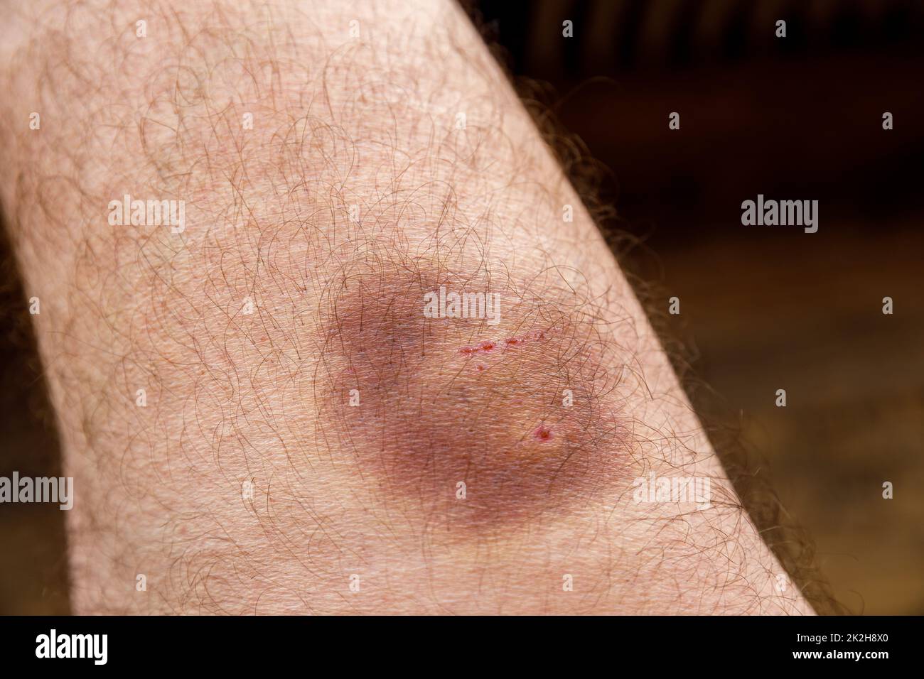 A big blue hematomo on a leg Stock Photo - Alamy