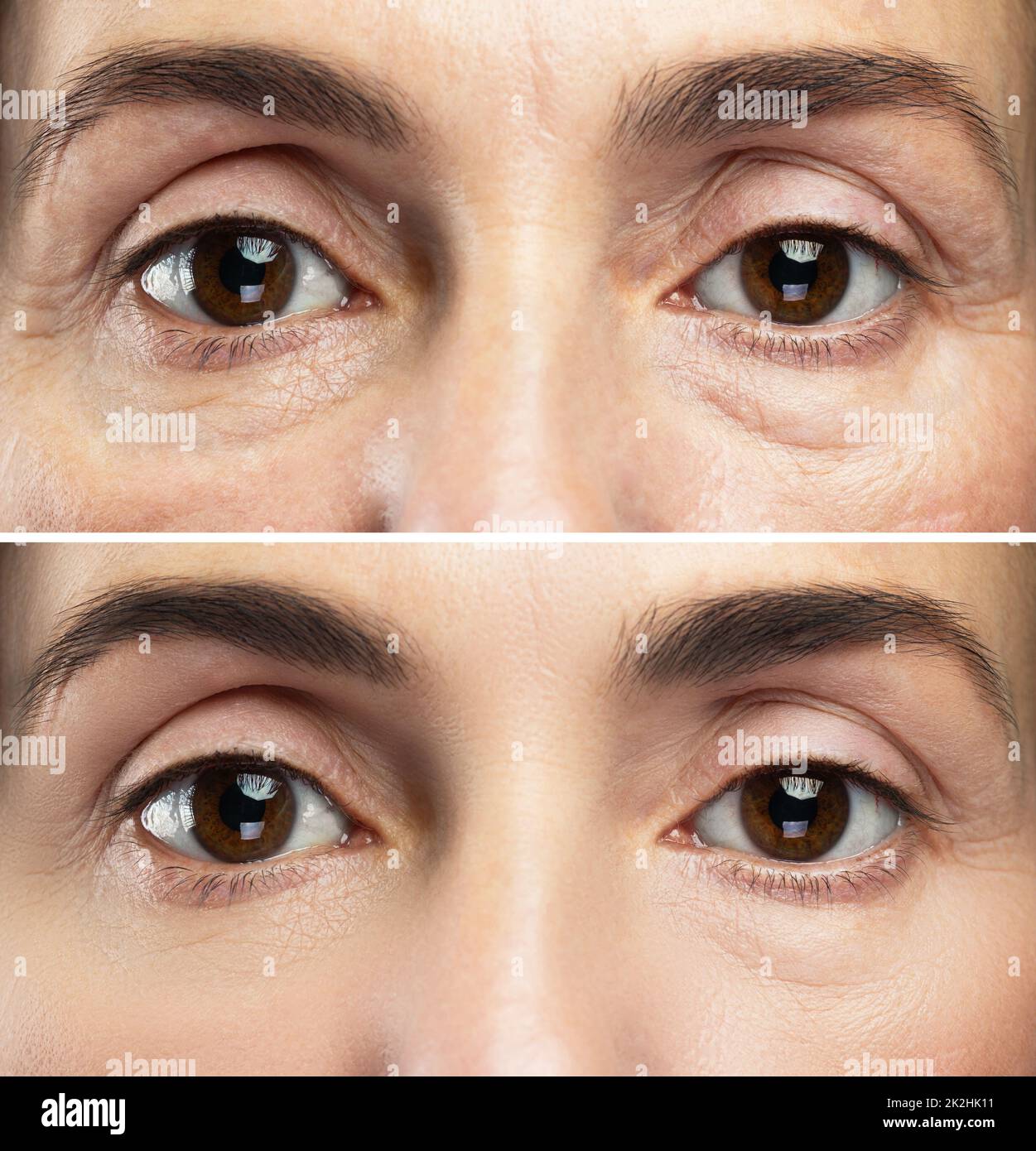 Woman before laser treatment hi-res stock photography and images - Alamy