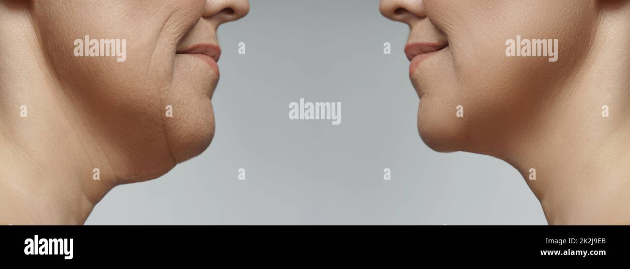 Double chin removal, facelift and neck liposuction Stock Photo - Alamy