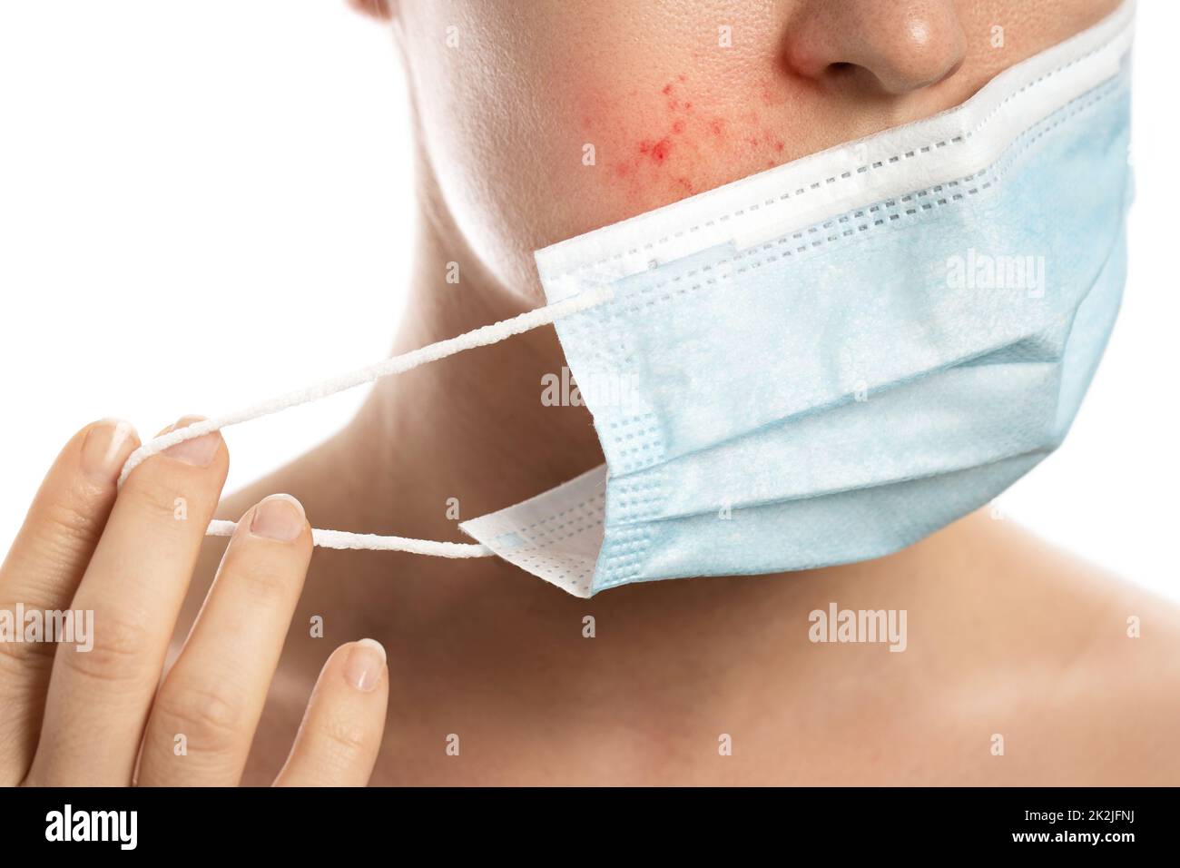 Maskne - acne breakouts from wearing a face mask Stock Photo - Alamy