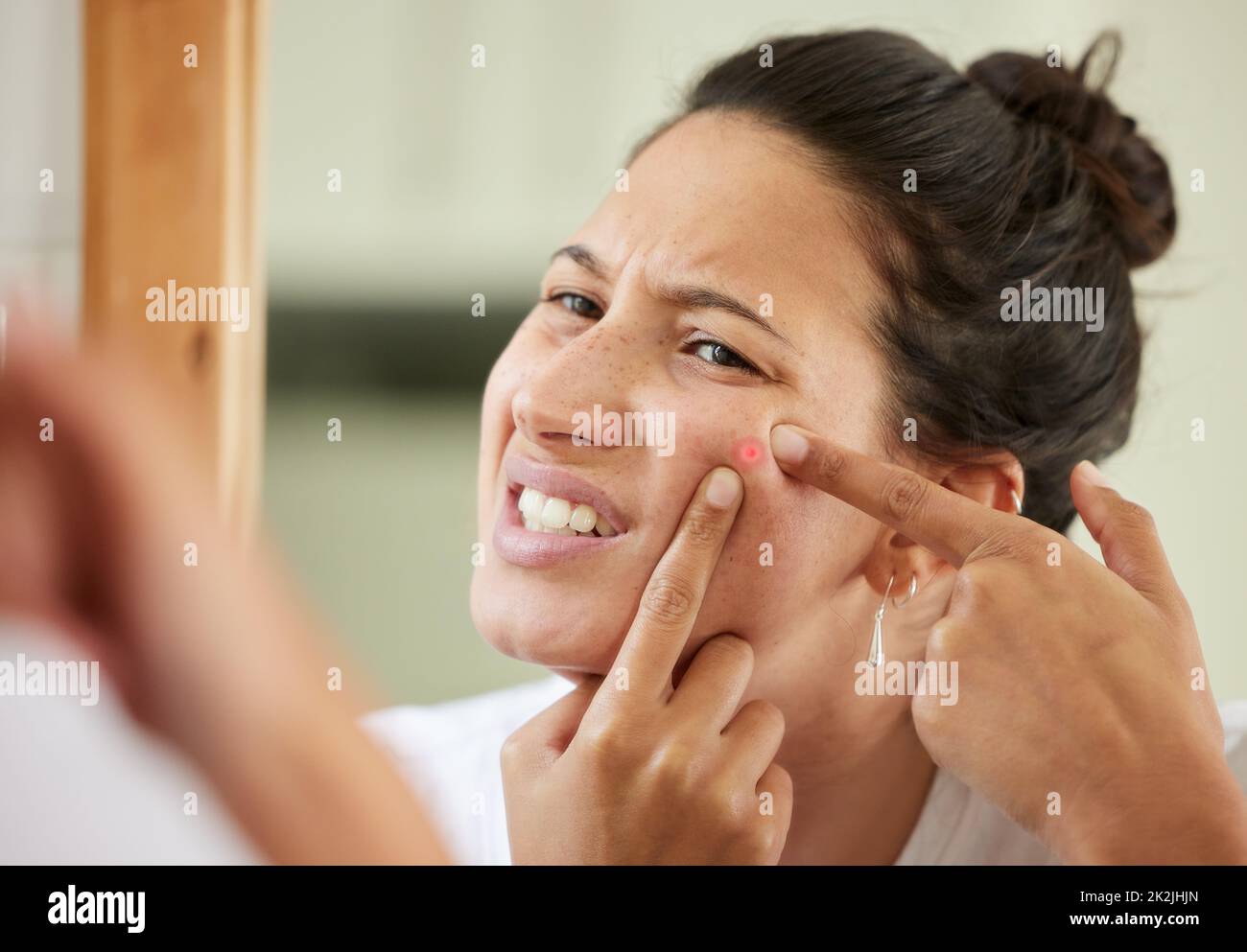 Popping Pimples Gross