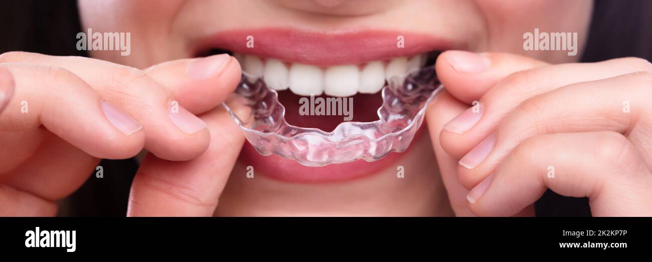 Aligner teeth hi-res stock photography and images - Alamy