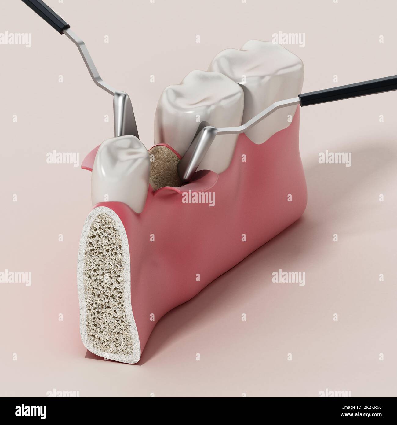3D illustration of mid-crestal incision dental operation. 3D ...