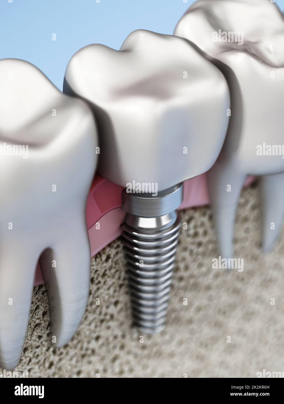 3D rendering of tooth implant showing jaw gum and bone layers. 3D ...