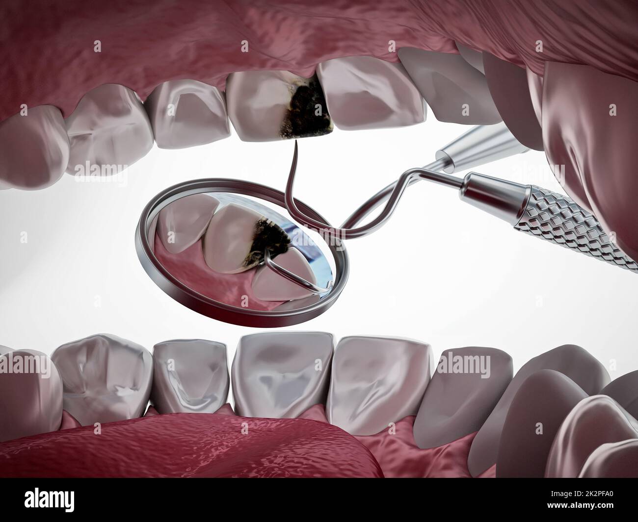 Decayed tooth diagnosis and treatment. 3D illustration Stock Photo - Alamy
