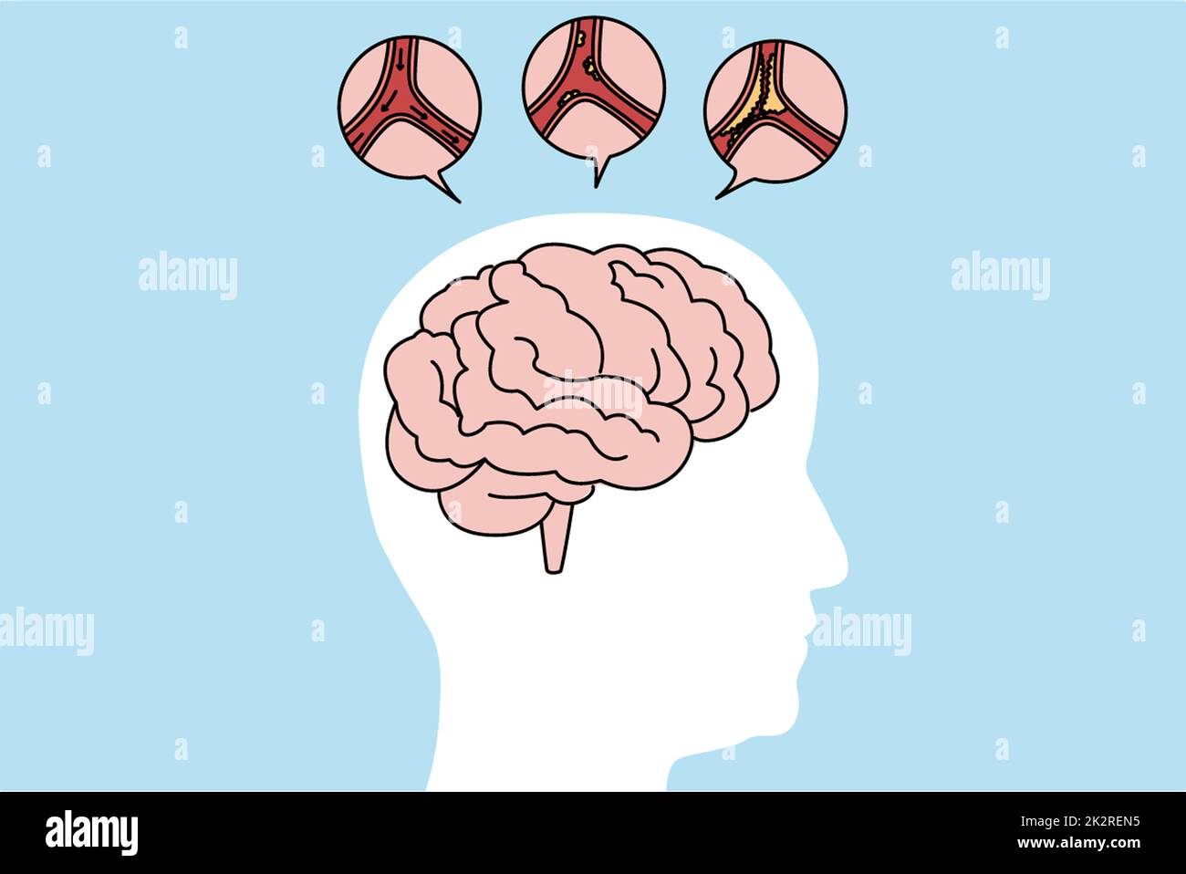 Medical illustration of human brain stroke Stock Photo - Alamy