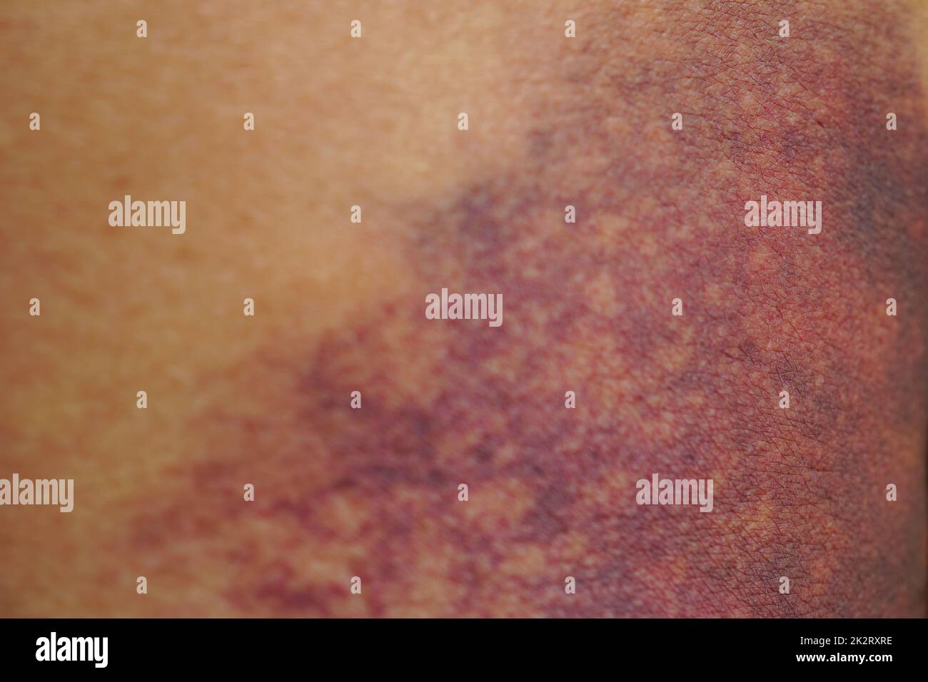 Purple bruise hi-res stock photography and images - Alamy