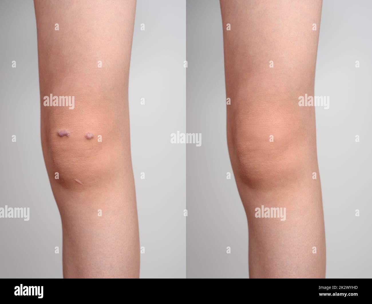 Hypertrophic and keloid scar hi-res stock photography and images - Alamy