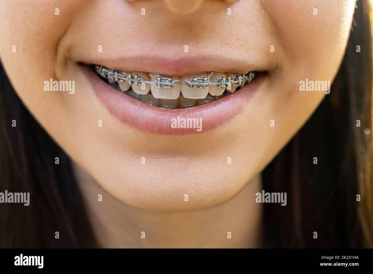 Beautiful Smiling Girl showing Retainer, Braces for Teeth Stock Photo ...
