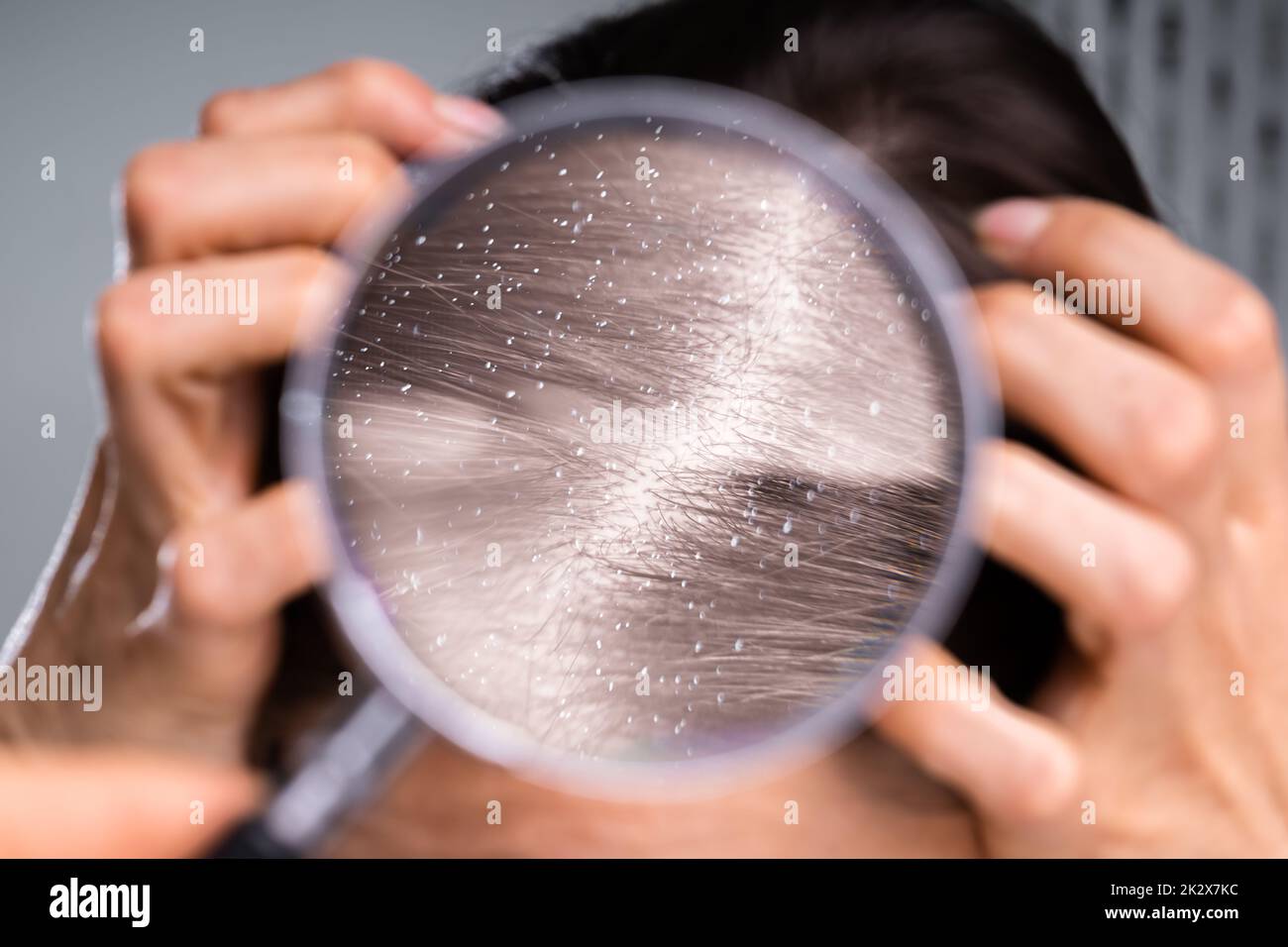Dandruff In Hair Seen Through Magnifying Glass Stock Photo - Alamy