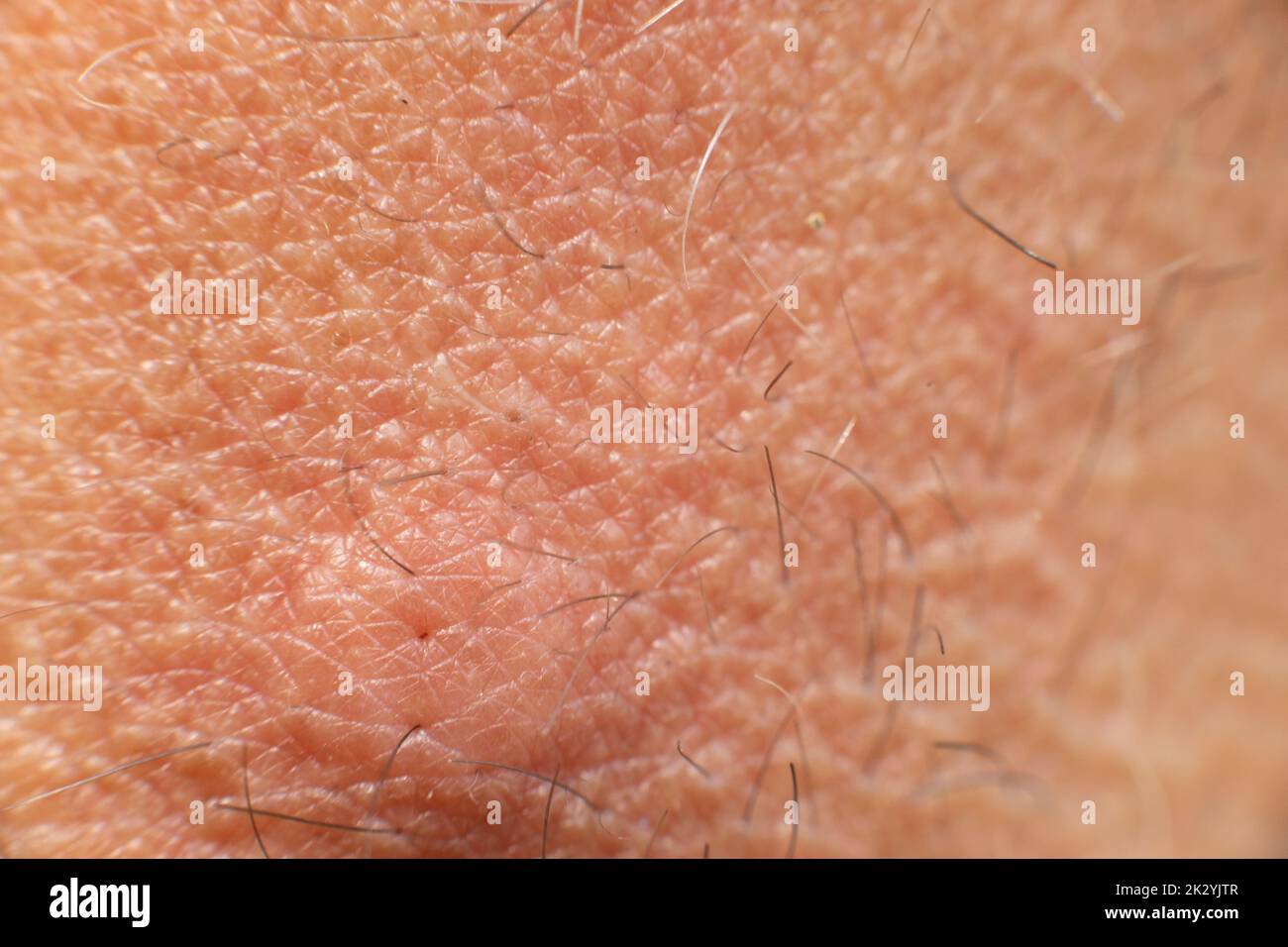 Swollen bee sting site, redness on the skin from a bee sting, close-up ...