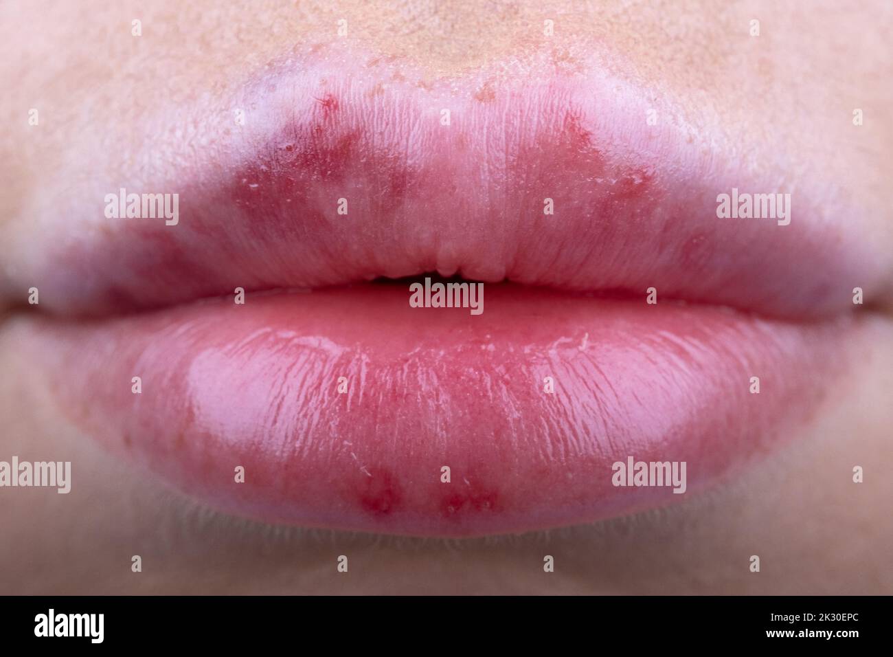 Marks bruising after collagen injections or fillers on Woman lips close ...