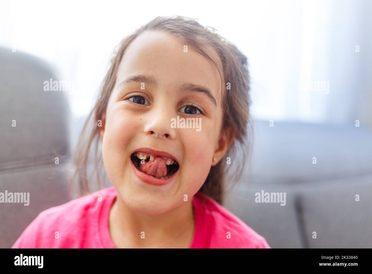 Young baby's teeth are shown close-up. A child's smile without one ...