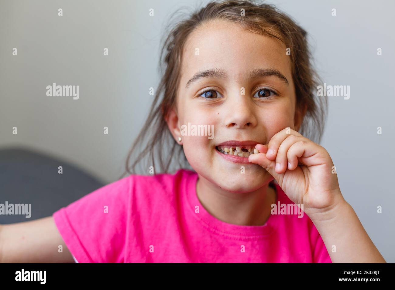 Young baby's teeth are shown close-up. A child's smile without one ...