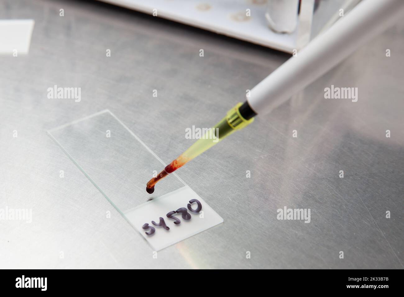 Bone marrow smear preparationin the laboratory. Blood smear ...