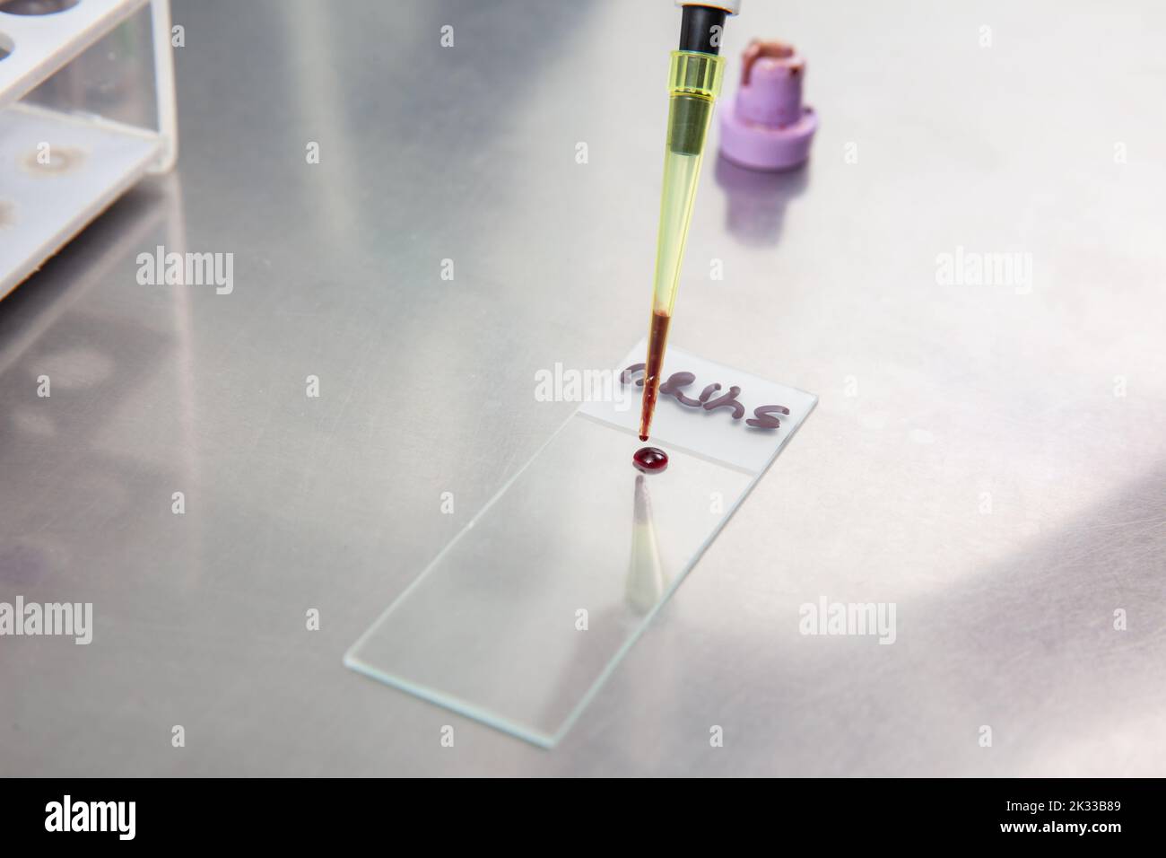 Bone marrow smear preparationin the laboratory. Blood smear ... Bone marrow smear preparationin the laboratory. Blood smear ...