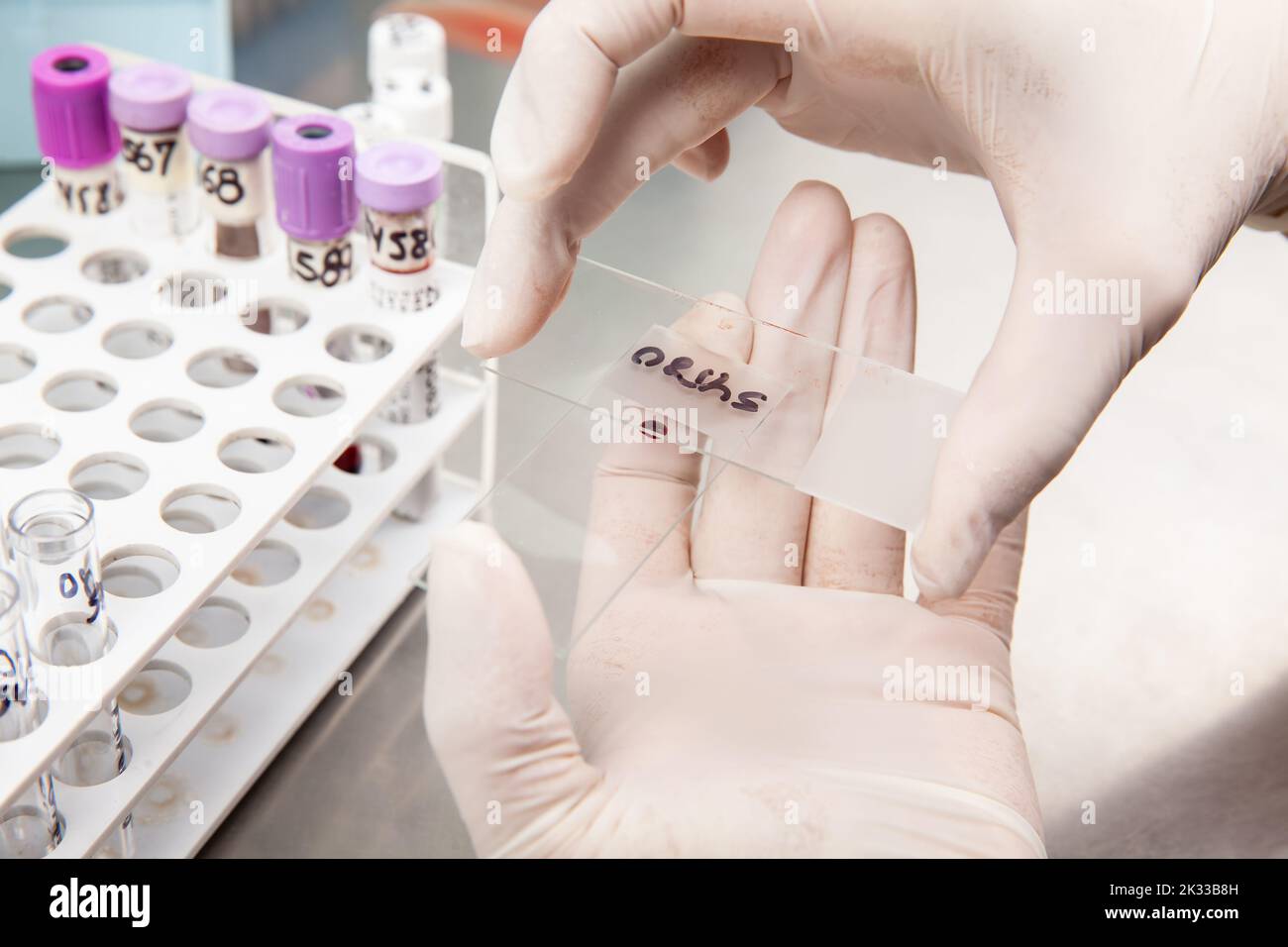 Scientist preparing a bone marrow smear in the laboratory. Blood smear ...