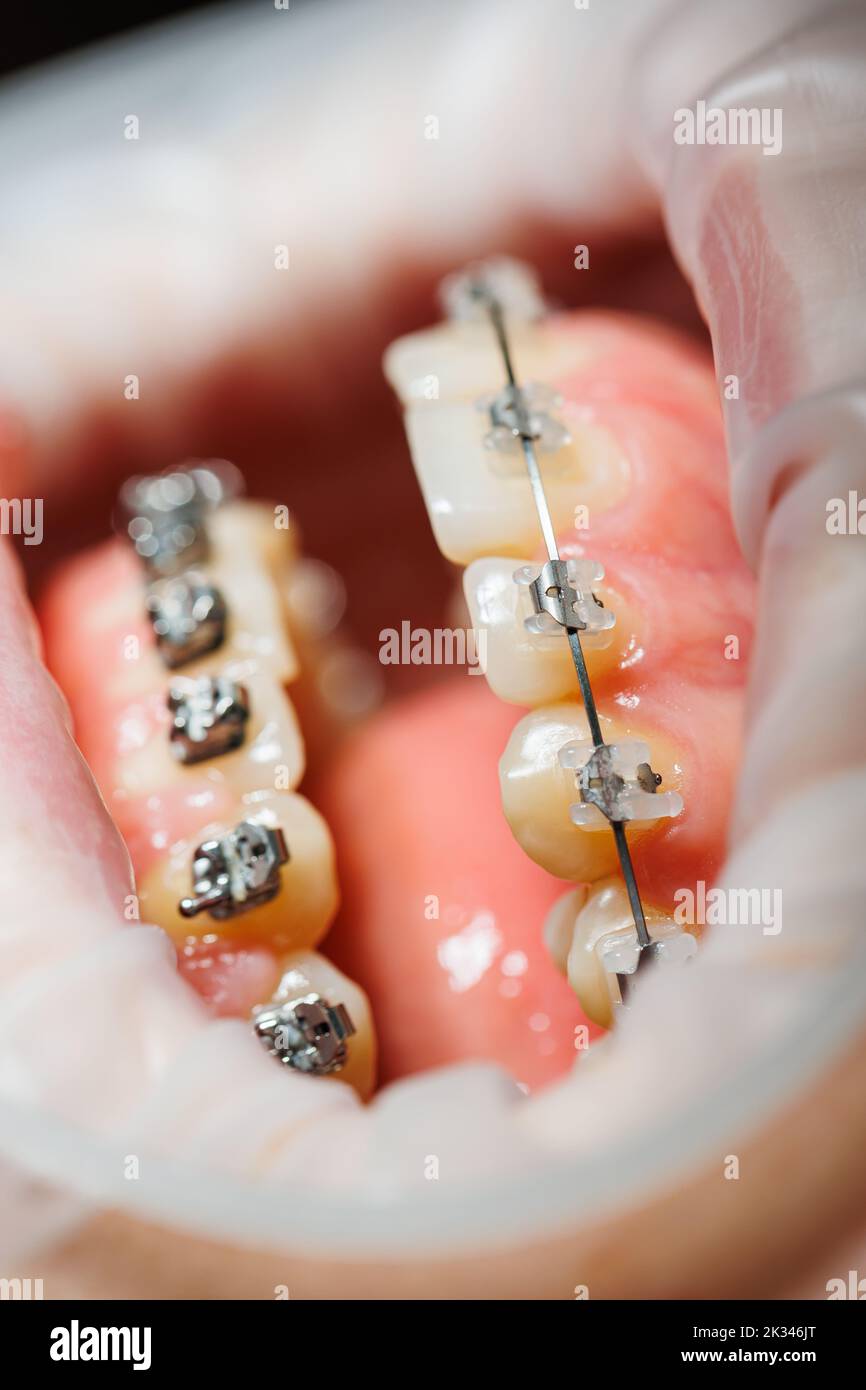 Close-up of teeth with metal braces. Orthodontic treatment of the jaw ...