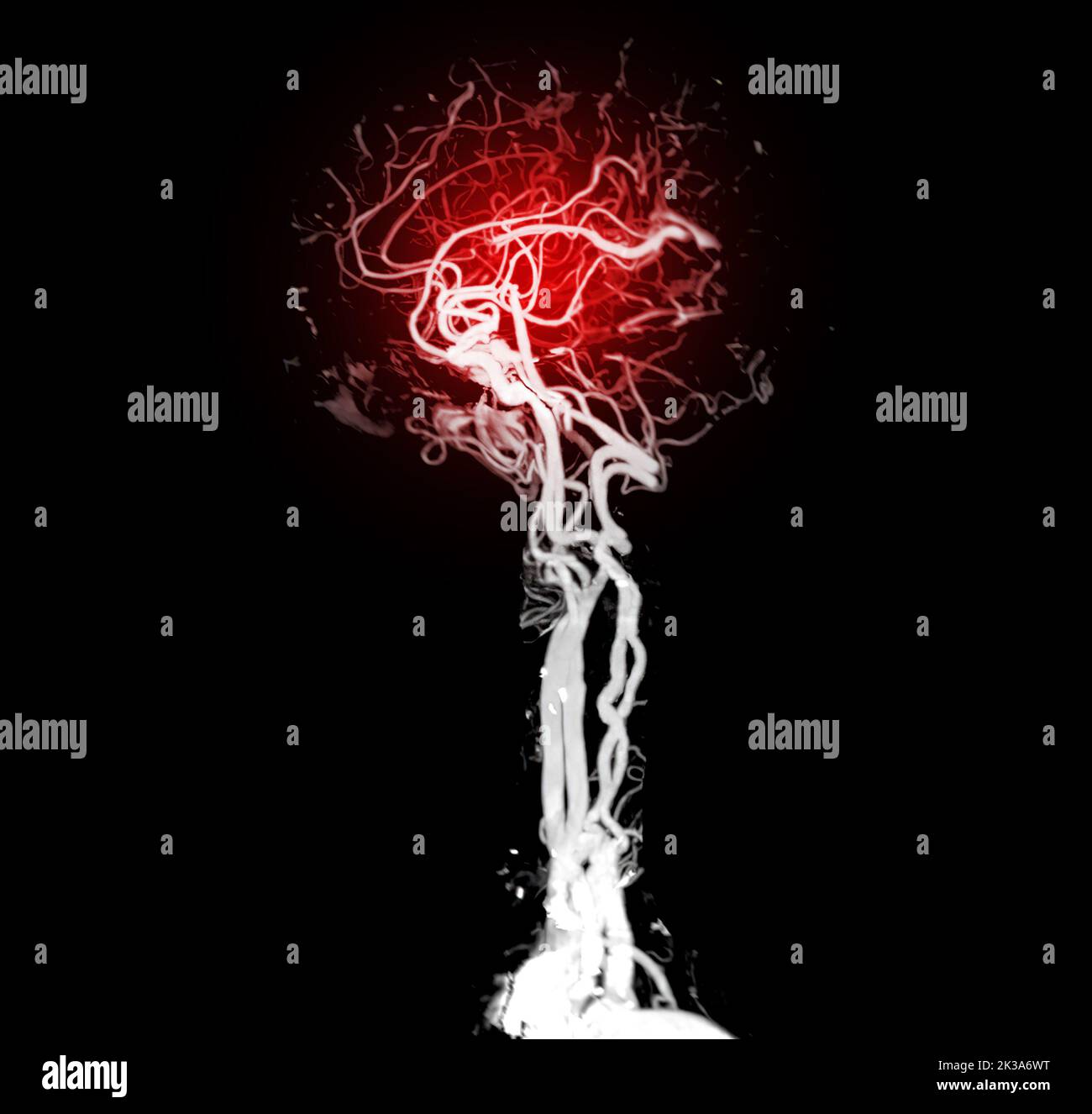 CTA brain or CT angiography of the brain 3D Rendering image for ...