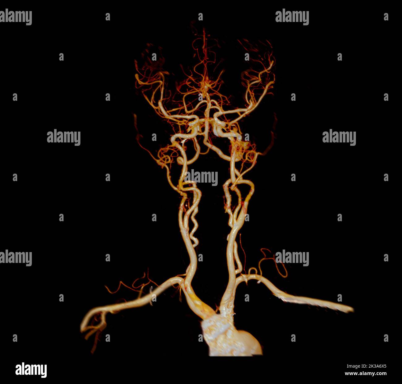 Cta Brain Or Ct Angiography Of The Brain 3d Rendering Image For