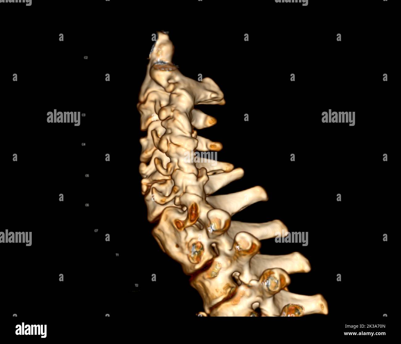 Ct Scan Of C Spine Or Cervical Spine 3d Rendering For Diagnosis