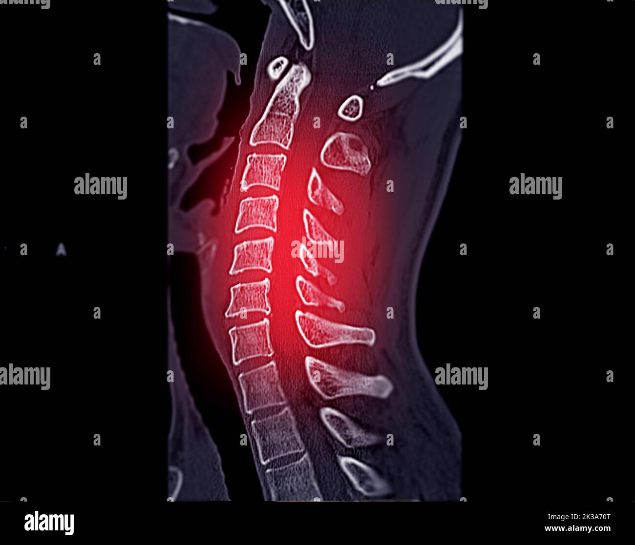 CT scan of C-Spine or Cervical spine 2D image for diagnosis fracture of ... CT scan of C-Spine or Cervical spine 2D image for diagnosis fracture of ...