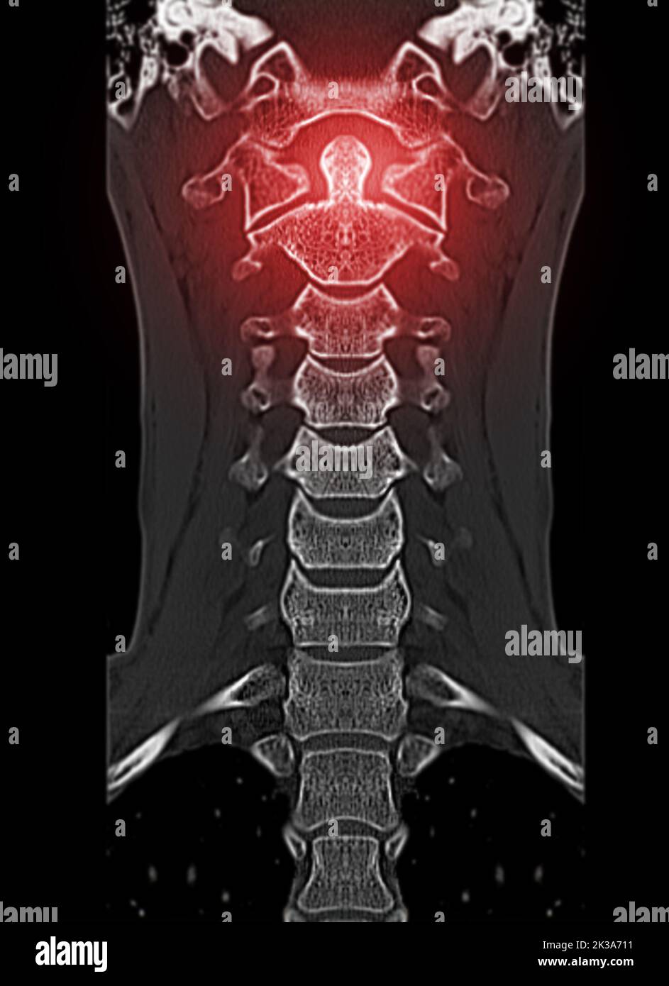 CT scan of C-Spine or Cervical spine 2D image for diagnosis fracture of ... CT scan of C-Spine or Cervical spine 2D image for diagnosis fracture of ...