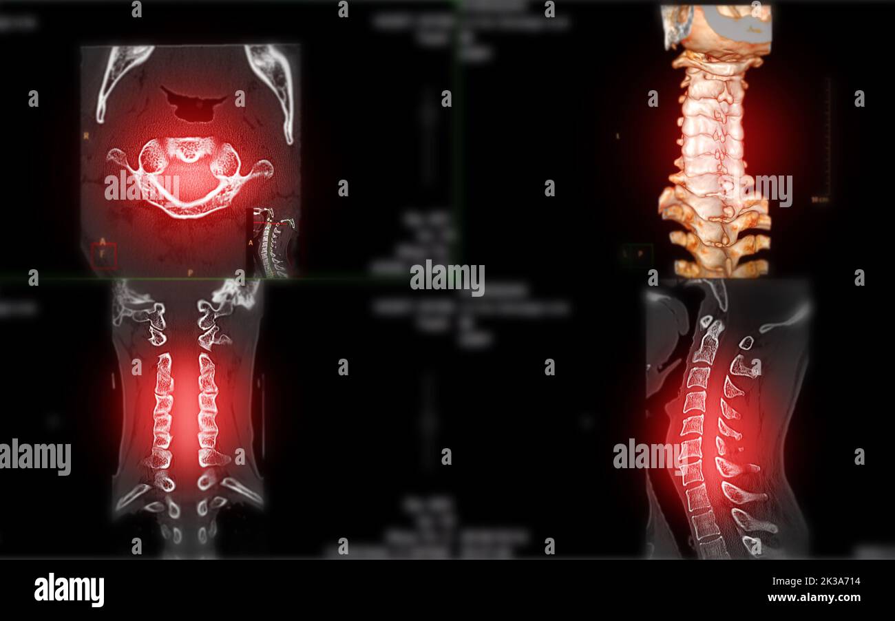 Collecion of CT scan of C-Spine or Cervical spine 3D rendering for ...