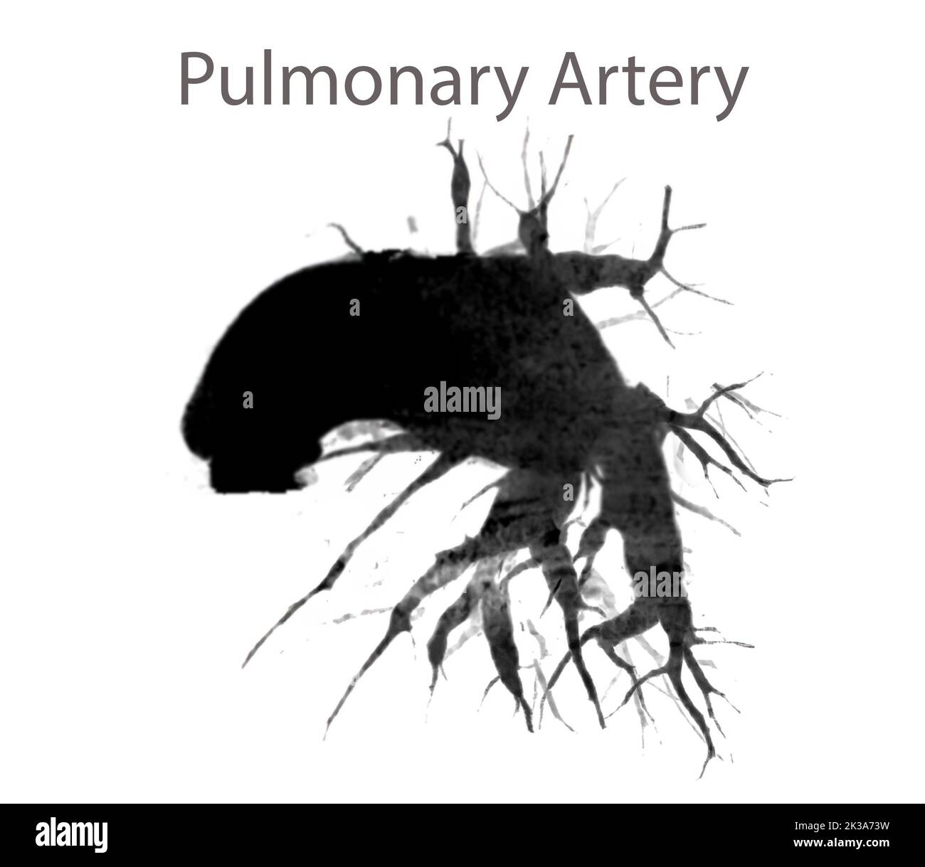 CTA pulmonary arteries showing branch of pulmonary artery Stock Photo ...